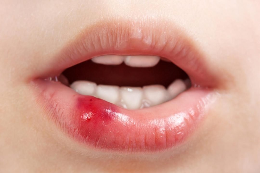 Soft Tissue Injuries in the Mouth Hoppers Crossing